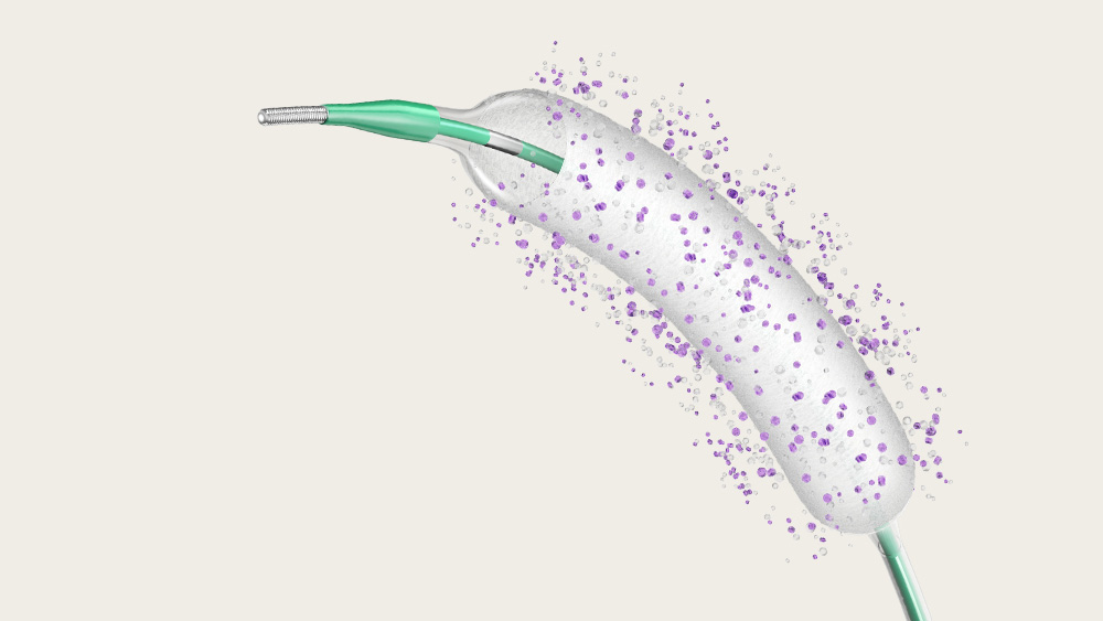Coronaire angioplastiek voor de behandeling van vasculaire stenose - B ...