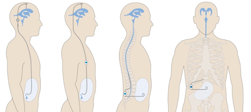 Assortiment MIETHKE hydrocephalusshunts - B. Braun