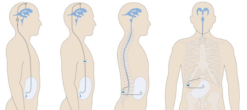 Assortiment MIETHKE hydrocephalusshunts - B. Braun