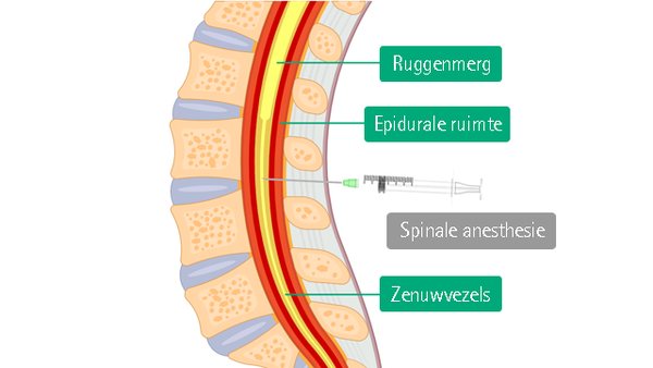 Wat is spinale anesthesie, wanneer wordt het toegepast en wat zijn de voordelen? - B. Braun