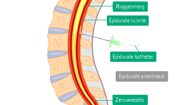 Wat is epidurale anesthesie, wanneer wordt het toegepast en wat zijn de ...