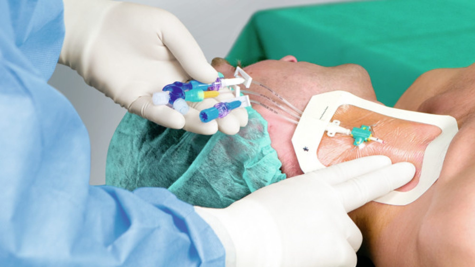 De juiste keuze voor vasculaire toegang bij infuustherapie - B. Braun