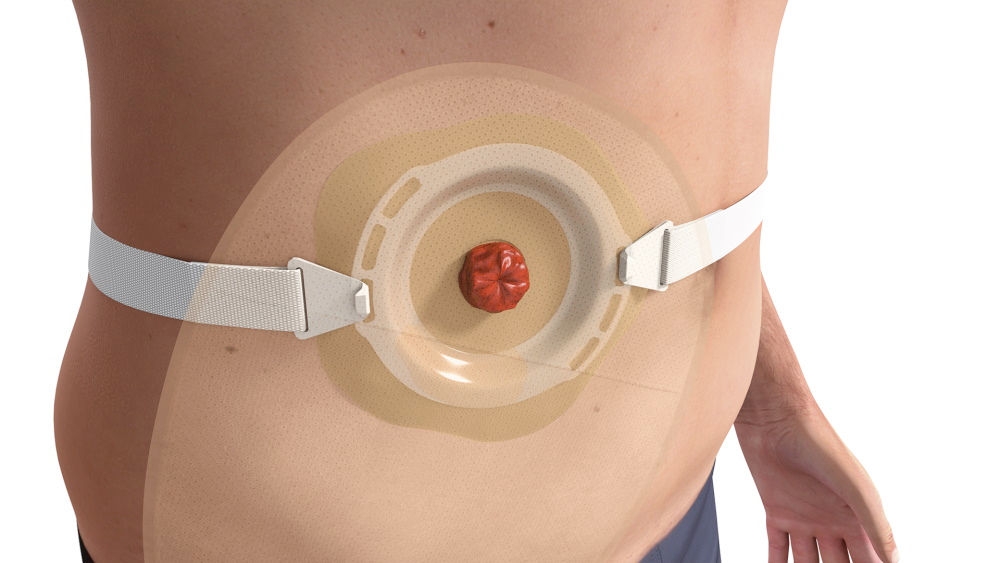 Convex stomamateriaal tegen stomalekkages - B. Braun