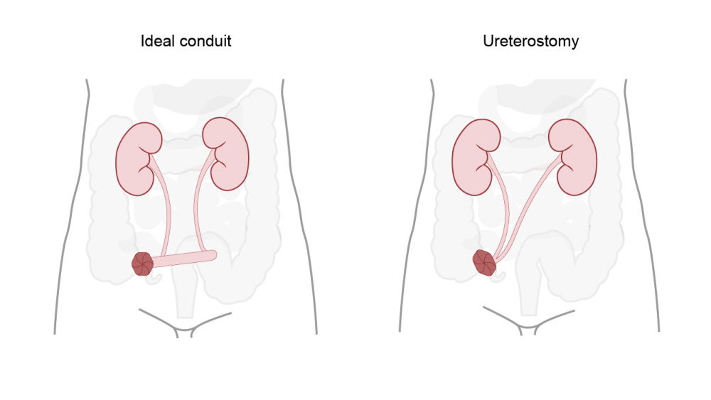 Wat is een stoma? - B. Braun