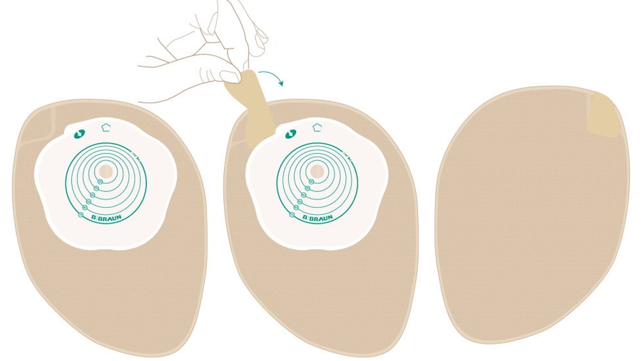 Kan ik zwemmen met een stoma? - B. Braun
