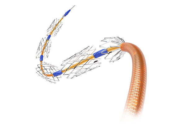 Perifere angioplastiek
